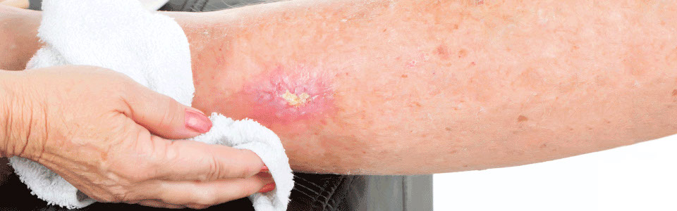 PRP therapy | Wanaka, NZ - wound healing PRP therapy | Wanaka, NZ - wound healing